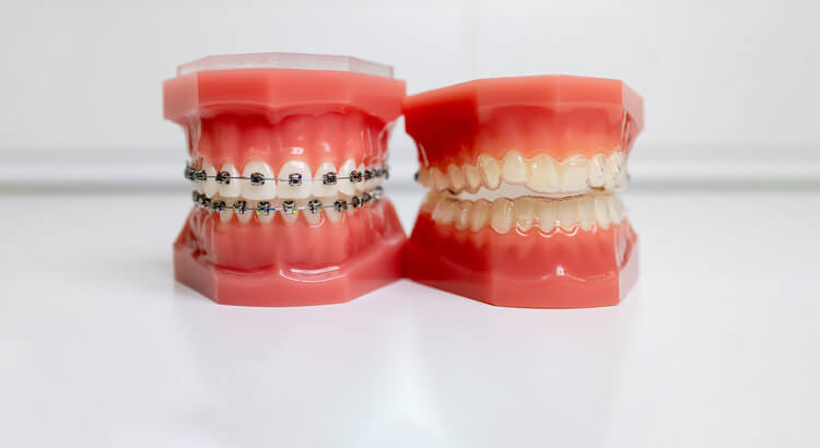 Orthodontic Hygiene Program | Pediatric Dental Care of Yukon | Yukon, OK